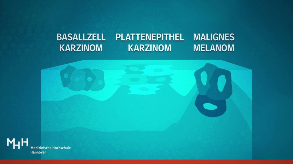MHH_Hautkrebsvorsorge | MHH | Initative Wissenschaft | Media | Top ...